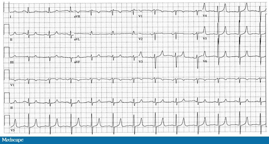 ECG Challenge: Anything Concerning?