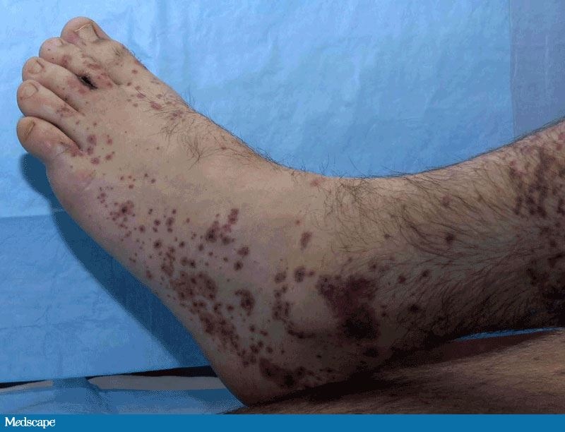 Soldier With Burning, Spreading Rash - Page 2