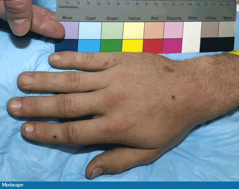 Soldier With Burning, Spreading Rash - Page 2