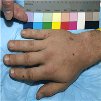 Soldier With Burning, Spreading Rash - Page 2