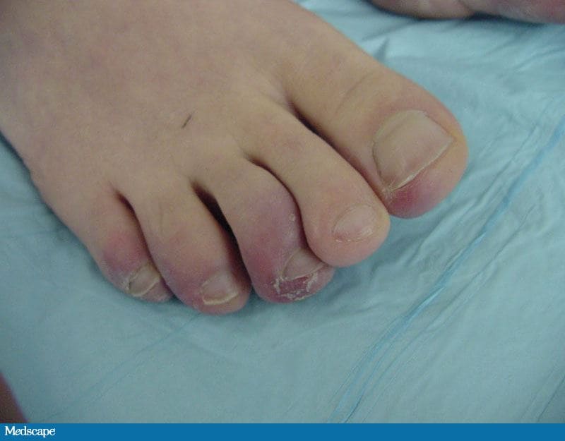 A 43-Year-Old With Painful, Discolored Toes - Page 2