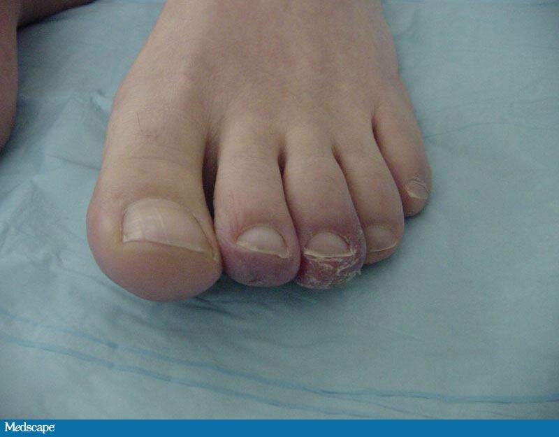 A 43-Year-Old With Painful, Discolored Toes - Page 2