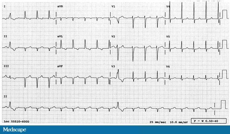 ECG Challenge: The Usefulness of PVCs, Part 1