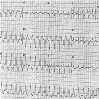 ECG Challenge: Palpitation Puzzle