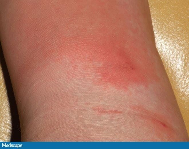 A Case-Based Approach to Acute Bacterial Skin and Skin Structure Infections