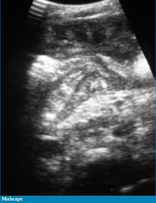 7-Month-Old Boy With Abdominal Pain and Rectal Bleeding - Page 5