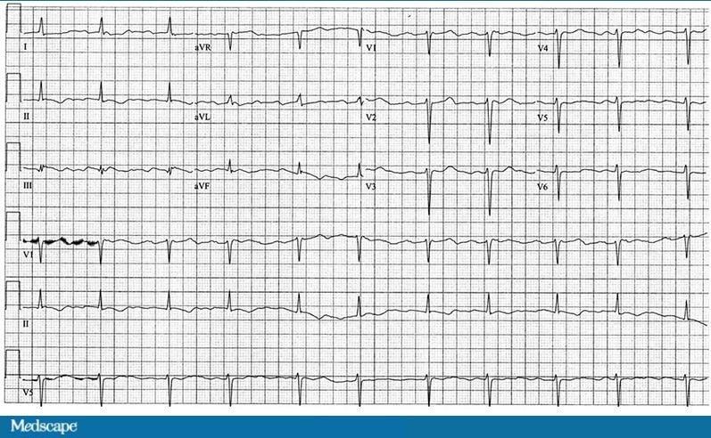 ECG Challenge: What's This Undulation?
