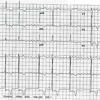 ECG Challenge: What Is This Irregularly Irregular Rhythm?