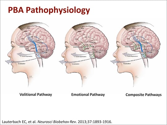 Pseudobulbar Affect or Psychiatric Condition? Guide to Diagnosis and ...