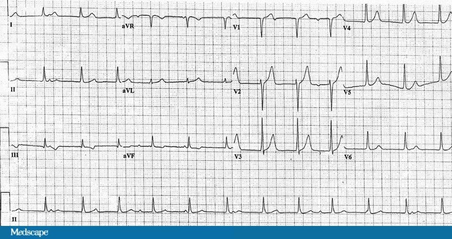 ECG Challenge: Revelations of a 'Routine' ECG (Transcript)