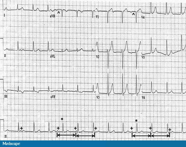 ECG Challenge: Revelations of a 'Routine' ECG (Transcript) - Page 2