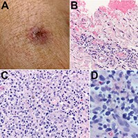 Rickettsia parkeri Rickettsiosis, Arizona, USA
