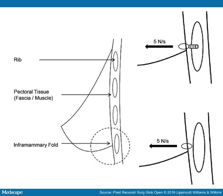 Inframammary Fold Reconstruction: A Biomechanical Analysis