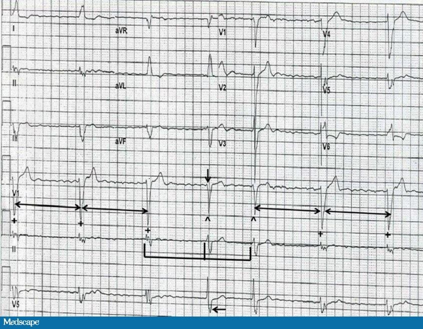 ECG Challenge: History of AF - Page 2