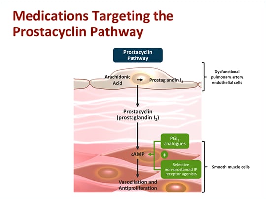 An Update on Oral Prostanoids: Advancing Care for PAH? (Transcript)