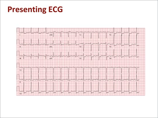 Evidence-Based Antiplatelet Therapy Across the ACS Spectrum: Hospital ...
