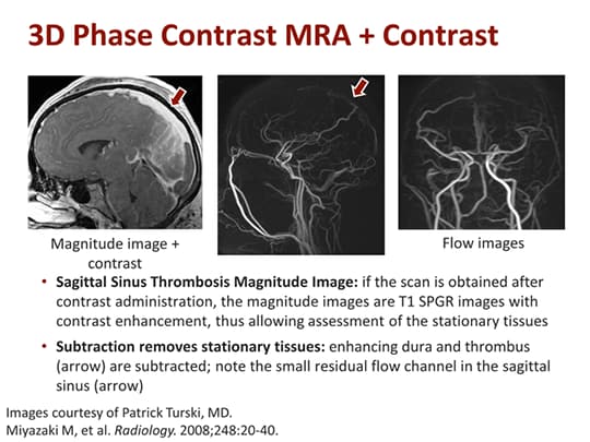 Best Practices for the Use of MRA in Stroke Diagnosis (Transcript)