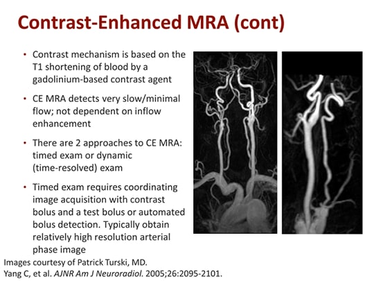 Best Practices for the Use of MRA in Stroke Diagnosis (Transcript)