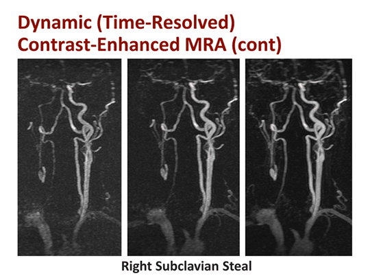 Best Practices for the Use of MRA in Stroke Diagnosis (Transcript)