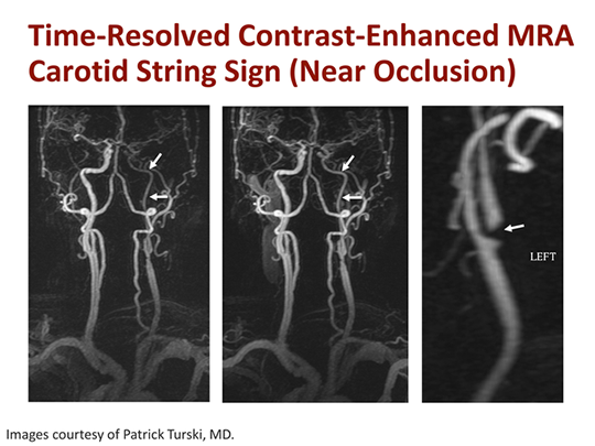Best Practices for the Use of MRA in Stroke Diagnosis (Transcript)