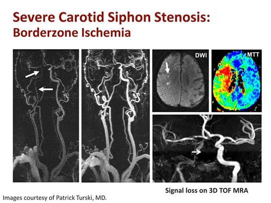 Best Practices for the Use of MRA in Stroke Diagnosis (Transcript)