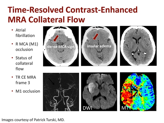 Best Practices for the Use of MRA in Stroke Diagnosis (Transcript)