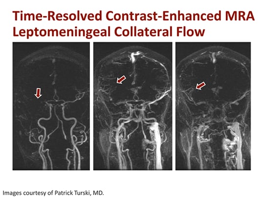 Best Practices for the Use of MRA in Stroke Diagnosis (Transcript)