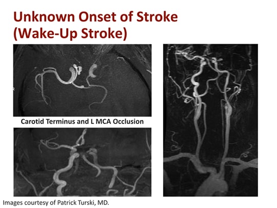 Best Practices for the Use of MRA in Stroke Diagnosis (Transcript)
