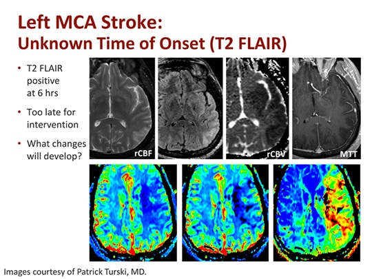 Best Practices for the Use of MRA in Stroke Diagnosis (Transcript)
