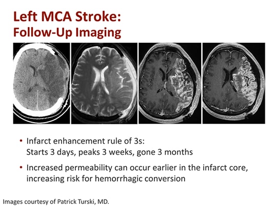 Best Practices for the Use of MRA in Stroke Diagnosis (Transcript)