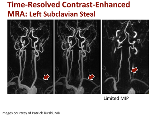 Best Practices for the Use of MRA in Stroke Diagnosis (Transcript)
