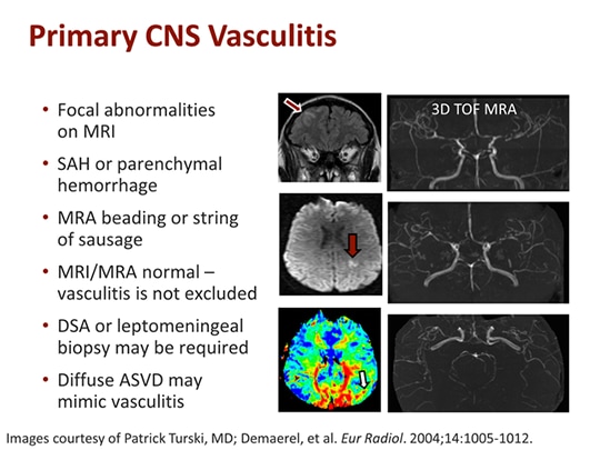 Best Practices for the Use of MRA in Stroke Diagnosis (Transcript)