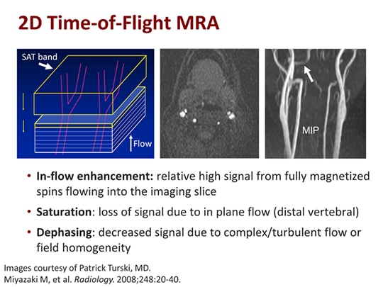Best Practices for the Use of MRA in Stroke Diagnosis (Transcript)