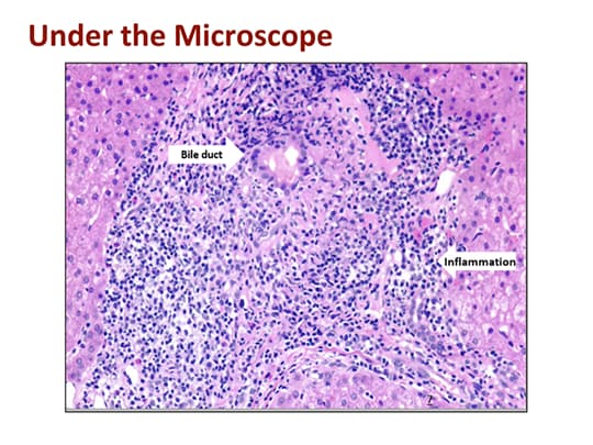 Primary Biliary Cholangitis: Pathophysiology, Diagnosis, and Natural ...