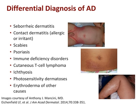 Essential Updates in Atopic Dermatitis: Pathophysiology, Prevalence ...