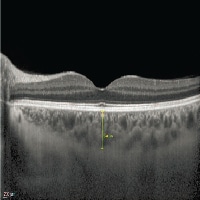Choroidal Changes Observed With Enhanced Depth Imaging Optical ...