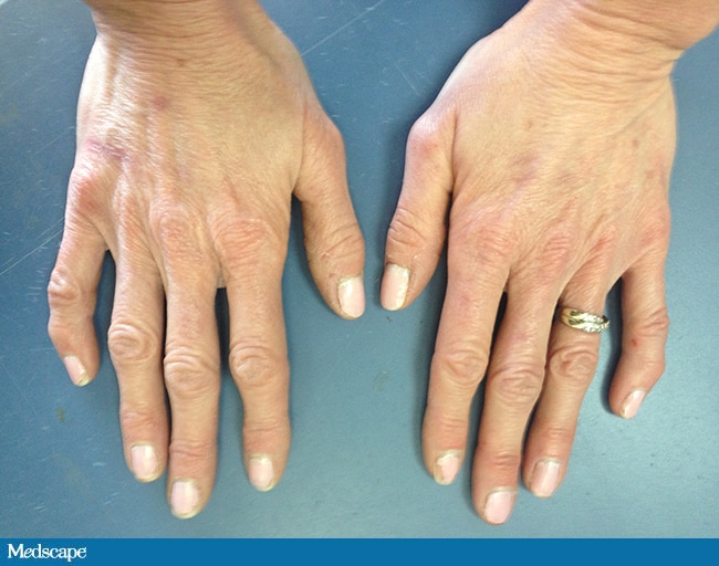 Case Challenge: A 42-Year-Old Woman Unhappy With Her Hand's Appearance ...