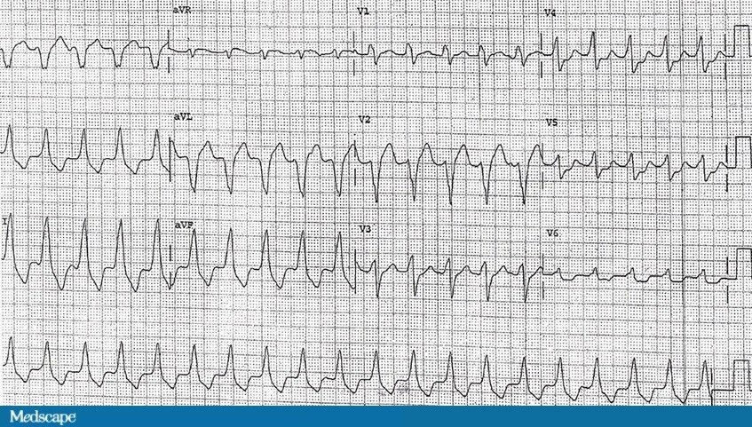 ECG Challenge: CAD, Palpitations, and SOB