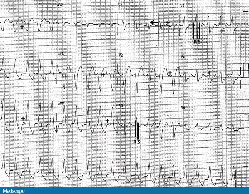 ECG Challenge: CAD, Palpitations, and SOB - Page 2