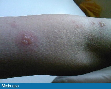 An 84-Year-Old With a Blistering Rash That Is Spreading
