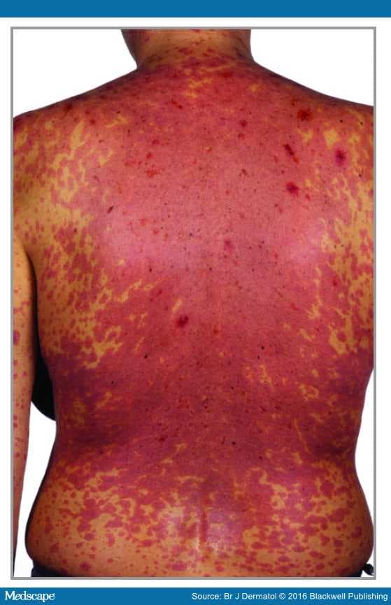 U.K. Guidelines for the Management of SJS/TEN in Adults 2016