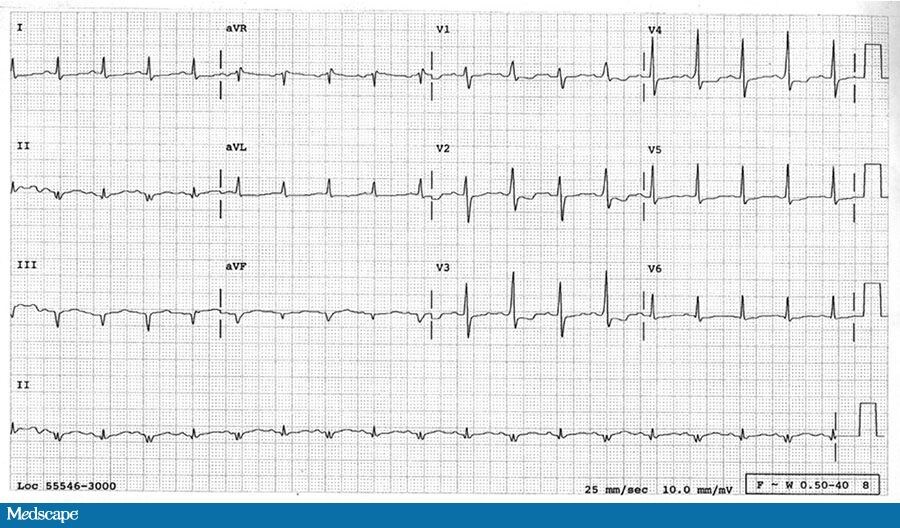 ECG Challenge: Anything to Get Excited About?