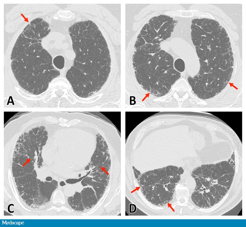 Critical Steps in Diagnosing and Treating Patients With Idiopathic ...