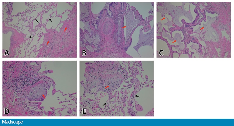 Critical Steps in Diagnosing and Treating Patients With Idiopathic ...