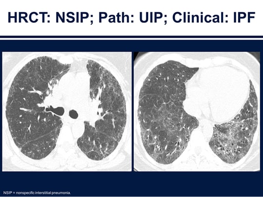 Idiopathic Pulmonary Fibrosis: Reading Between the Lines to Expedite ...