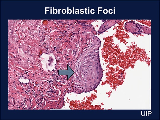 Idiopathic Pulmonary Fibrosis: Reading Between the Lines to Expedite ...