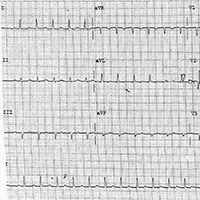 ECG Challenge: Respiratory Distress and a Rapid Rate