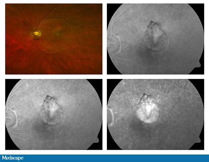 Innovations in Neovascular AMD: Emerging Therapies and Evidence Updates