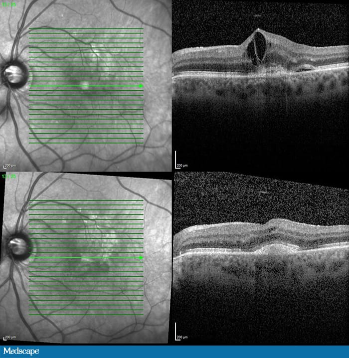 Innovations in Neovascular AMD: Emerging Therapies and Evidence Updates