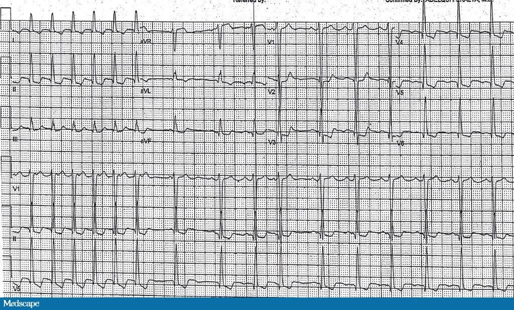ECG Challenge: Exercise-Induced Palpitations